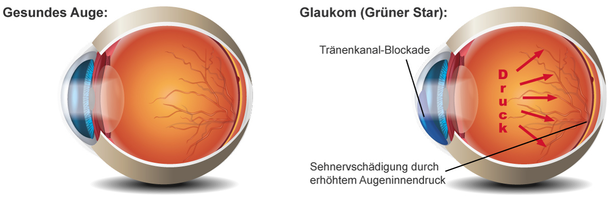 Glaukom (Grüner Star) - Augenheilzentrum im Rad
